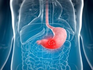 Esophago Gastric Surgery | LGI Hospital