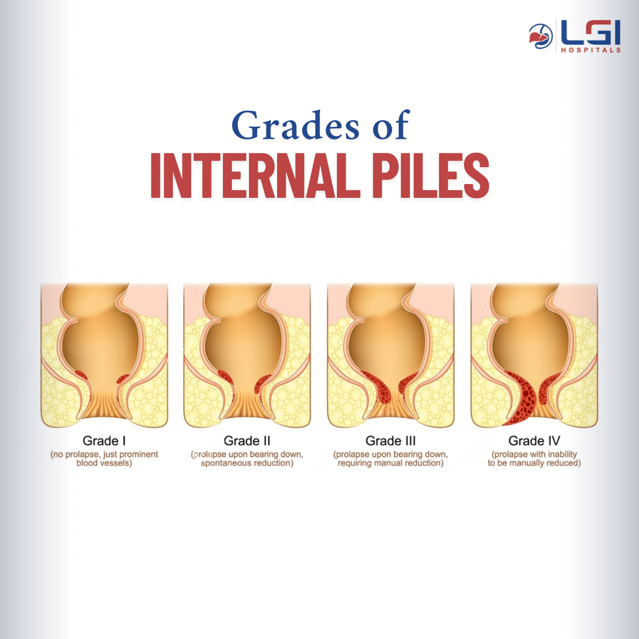 Types of Piles: Causes, Symptoms & When to See a Doctor